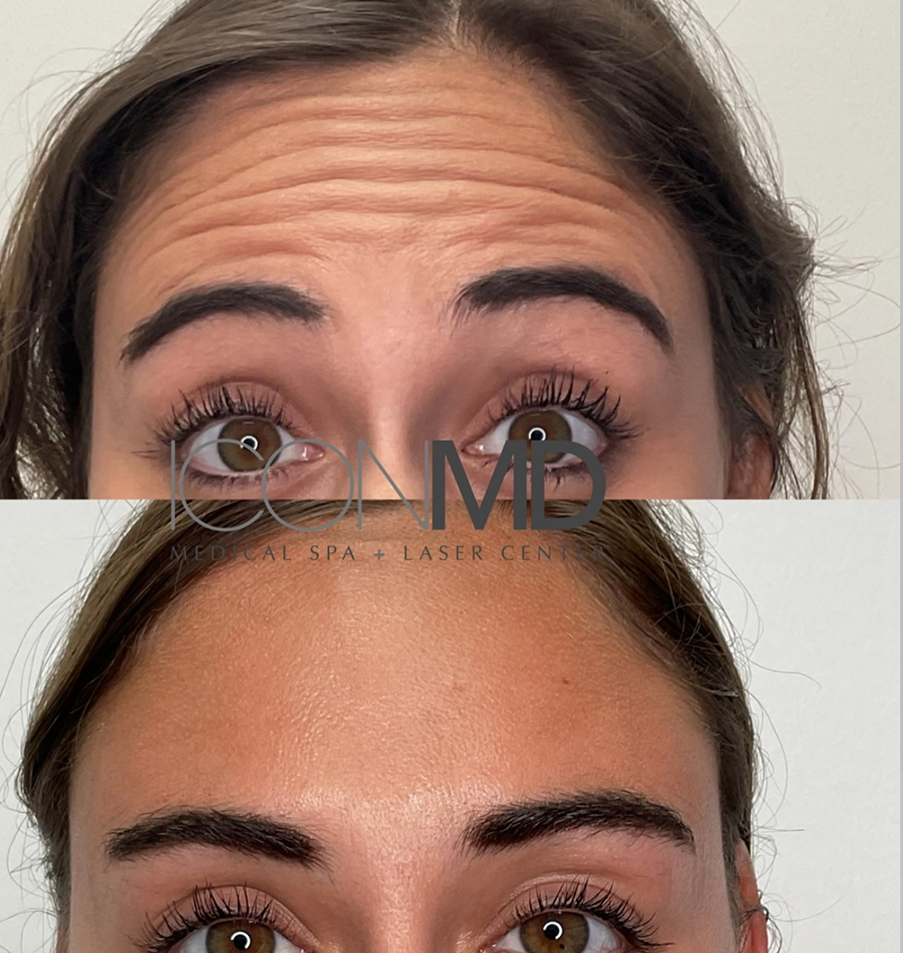 Botox Cosmetic Injections | Boston, MA | Waltham, MA | Icon MD
